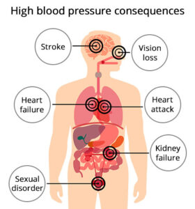 Hypertension Treatment in NYC | Best High Blood Pressure Specialists