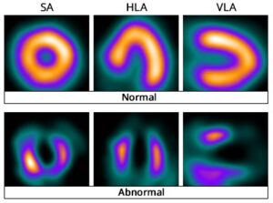 Cardiac Nuclear Stress Test in Manhattan, New York City